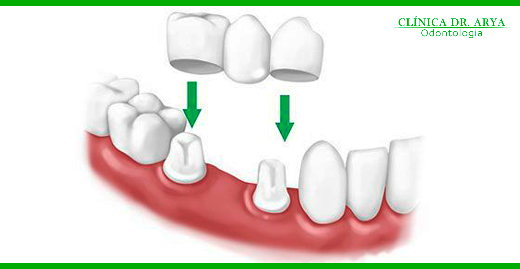 As vantagens de escolher uma Ponte Fixa em vez de Implantes Dentários ...