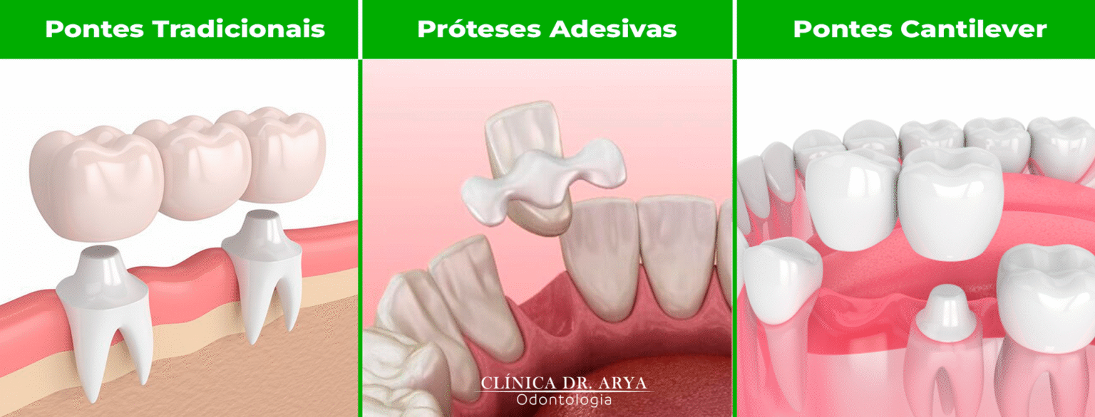 As vantagens de escolher uma Ponte Fixa em vez de Implantes Dentários ...