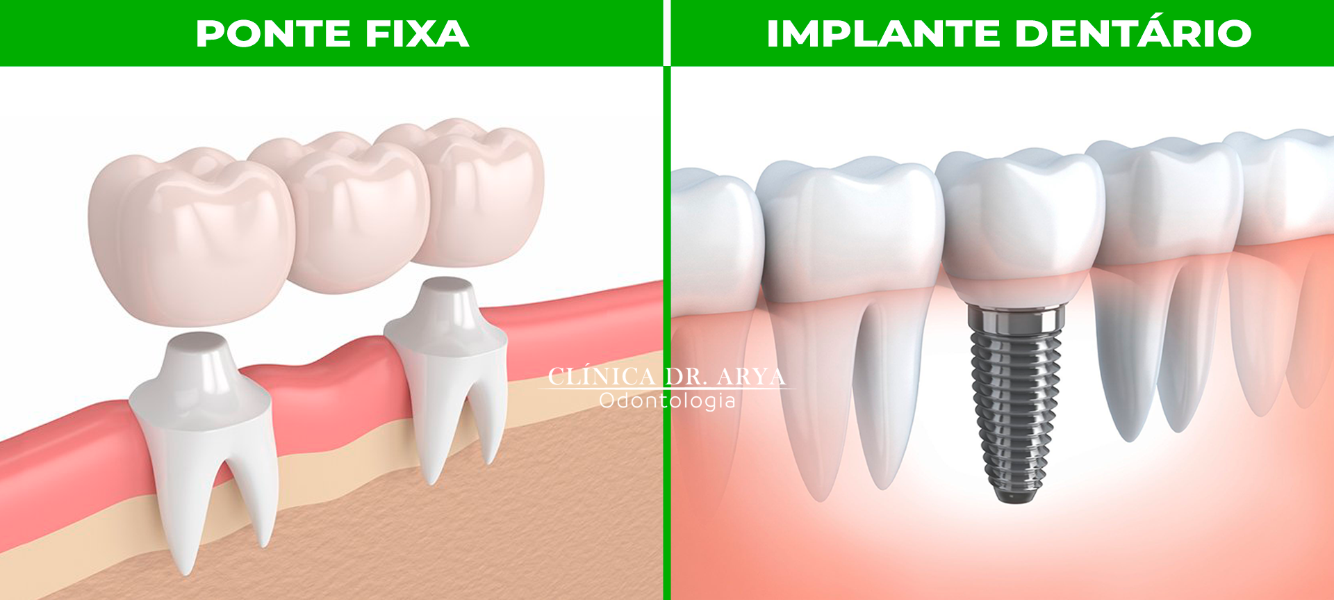 As vantagens de escolher uma Ponte Fixa em vez de Implantes Dentários ...